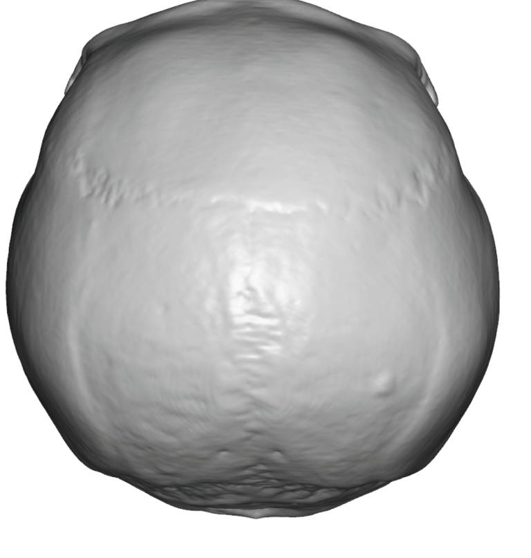 flat back of head 3D CT scan top view Dr Barry Eppley - Explore Plastic ...