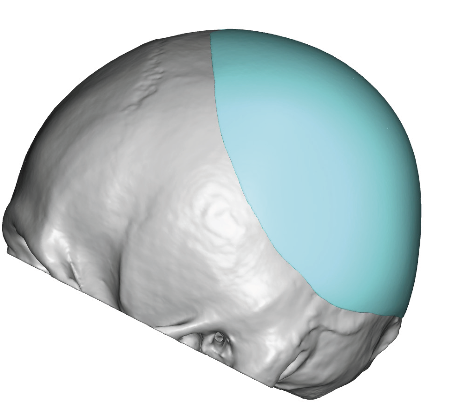 Plastic Surgery Case Study - Custom Skull Implant for Congenital Flat ...