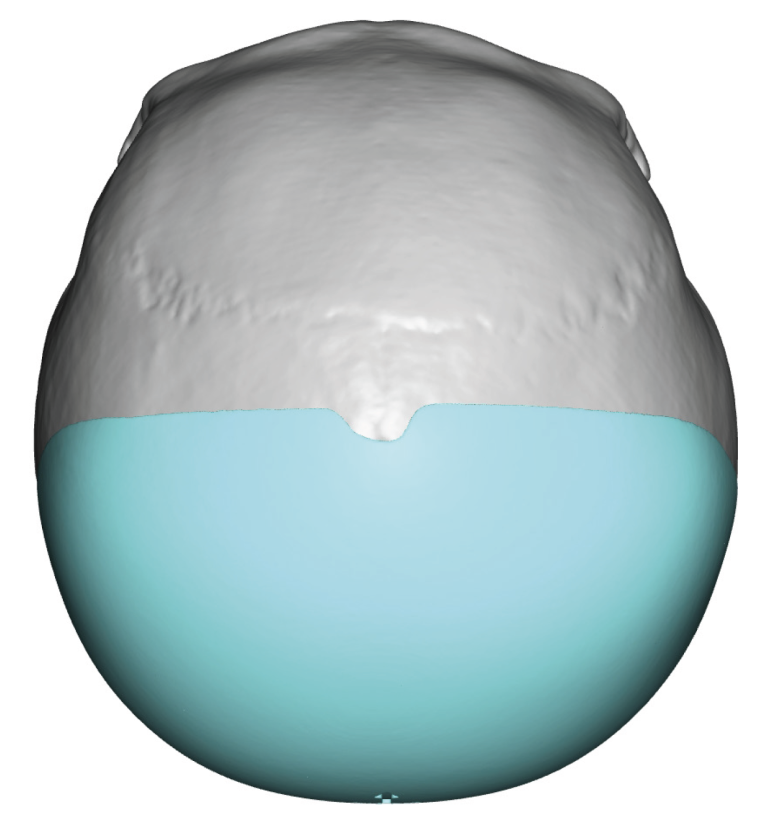 Plastic Surgery Case Study - Custom Skull Implant for Congenital Flat ...