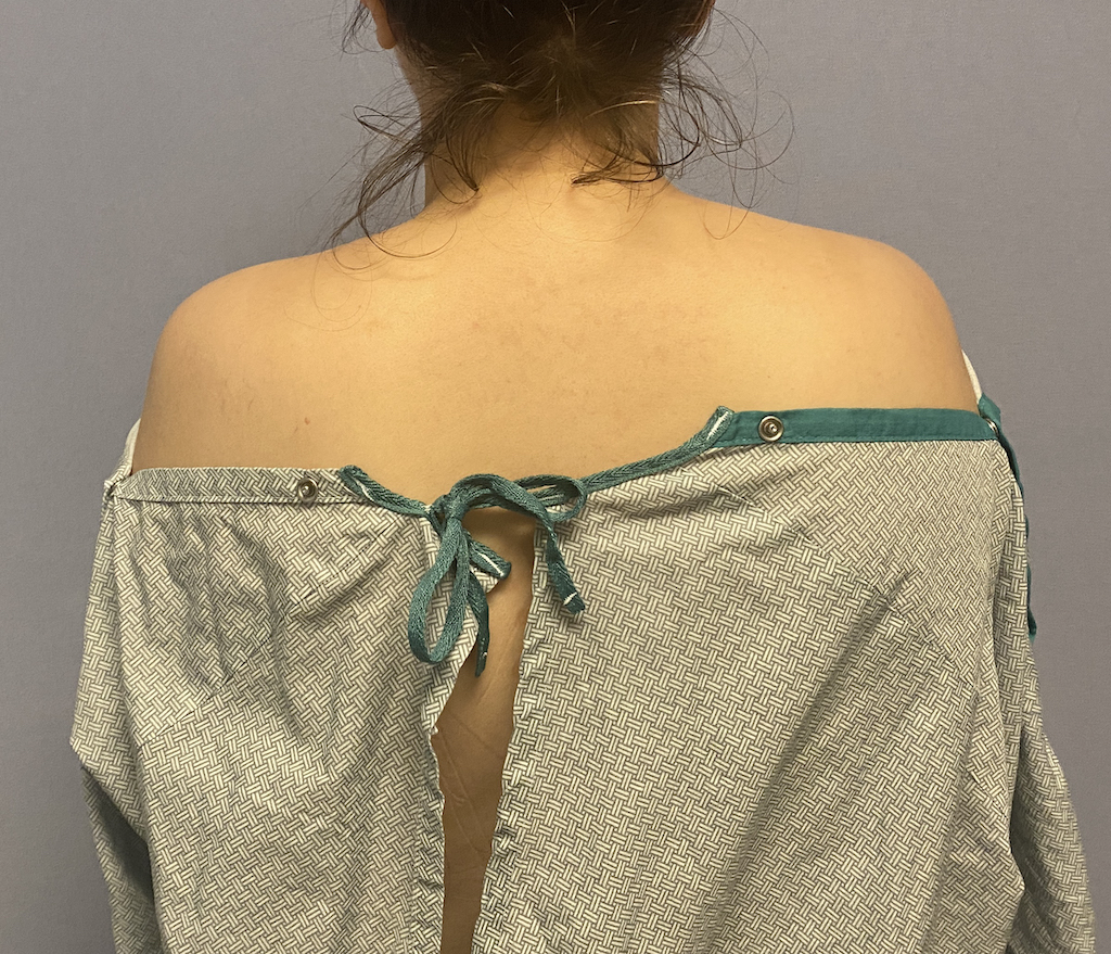 Plastic Surgery Case Study - Long Term Results In Cis-Female Shoulder ...