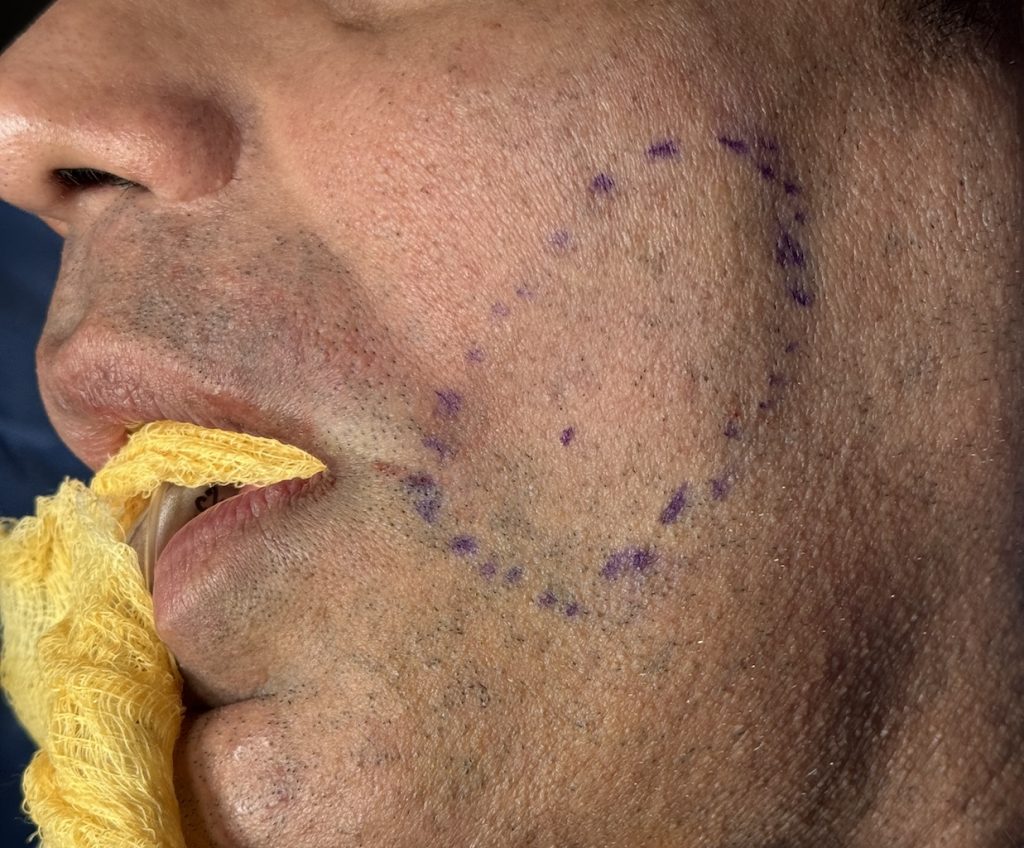 Technical Strategies - Combining Buccinator Myectomies and Perioral ...