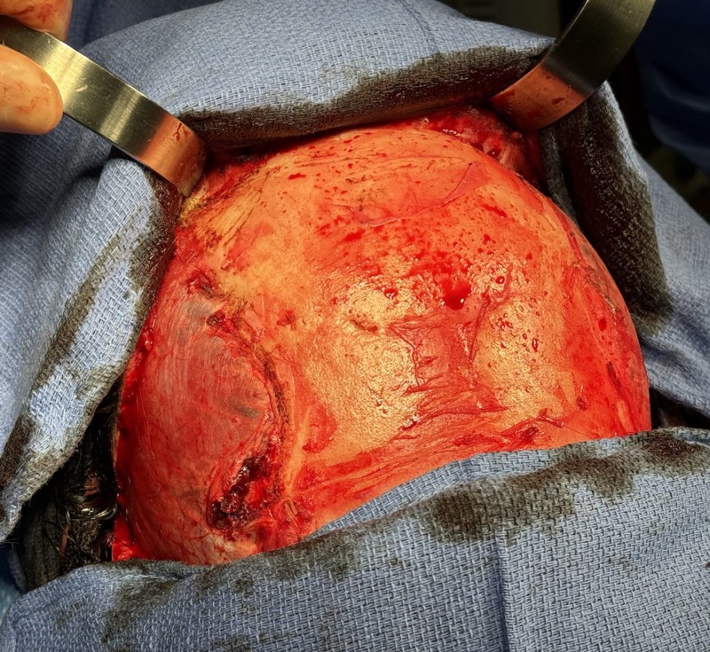 left temporal muscle Dr Barry Eppley - Explore Plastic Surgery