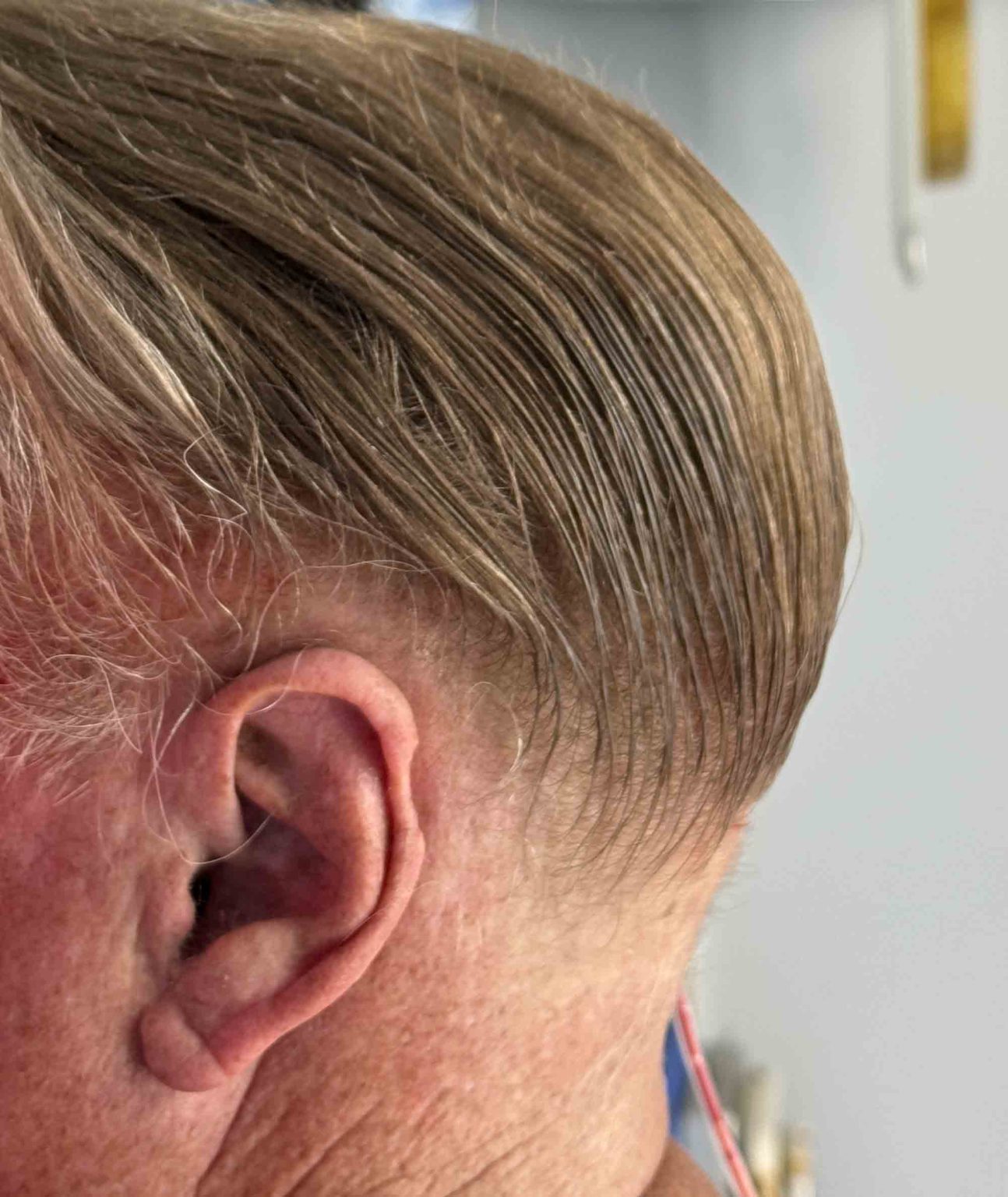 Plastic Surgery Case Study - Male Flat Back of the Head Custom Skull ...
