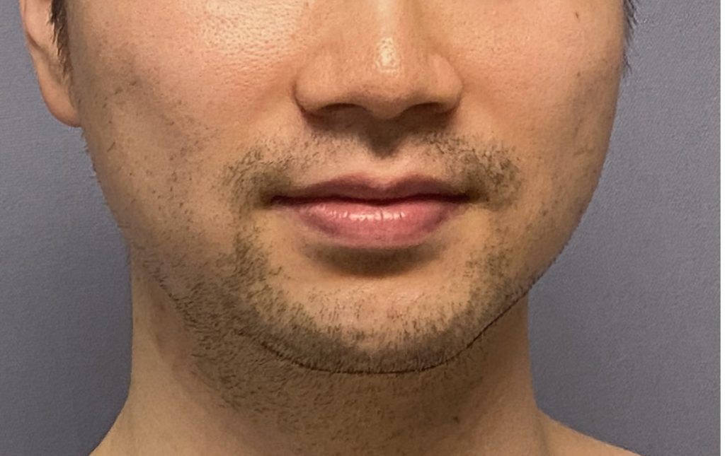 Plastic Surgery Case Study - Custom Chin Implant for Asymmetry: A 45 ...