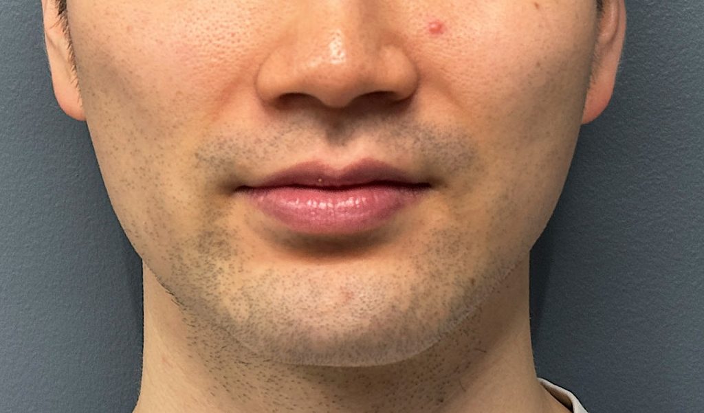 Plastic Surgery Case Study - Custom Chin Implant for Asymmetry: A 45 ...