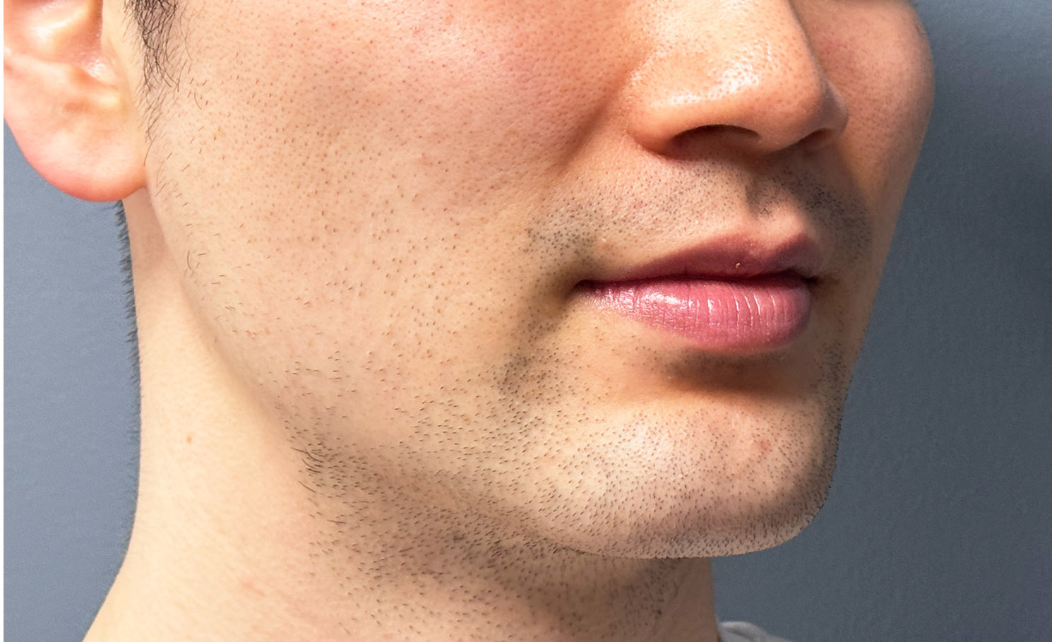 Plastic Surgery Case Study - Custom Chin Implant for Asymmetry: A 45 ...