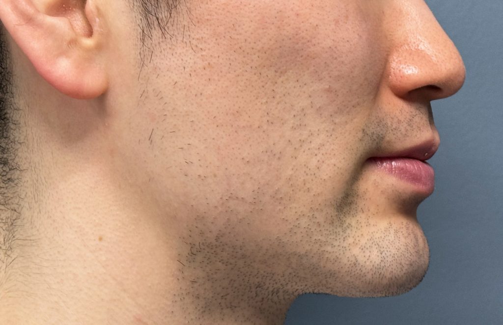 Plastic Surgery Case Study - Combined Custom Chin Implant with Buccal ...