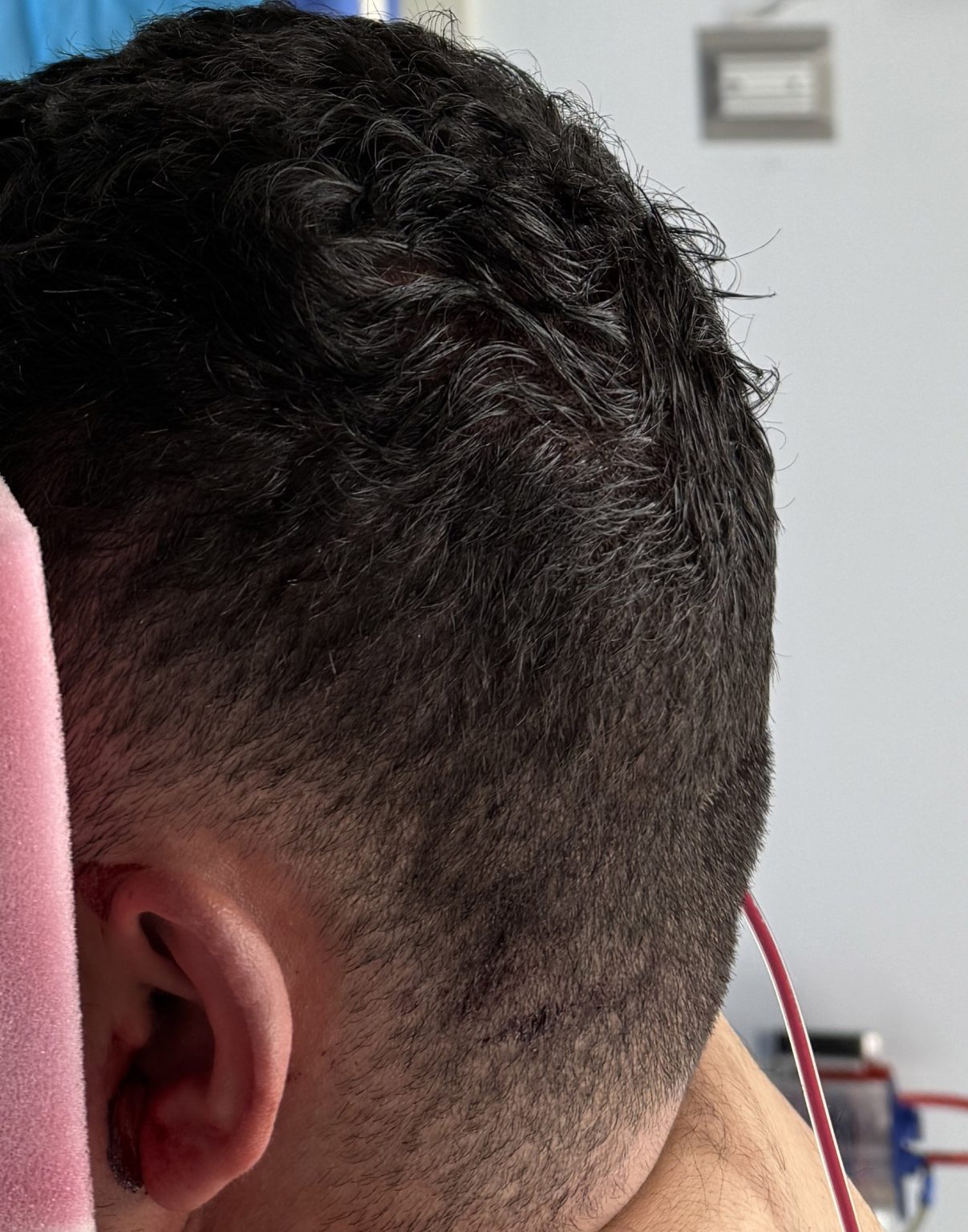 Plastic Surgery Case Study - Custom Skull Implant for Congenital Flat ...