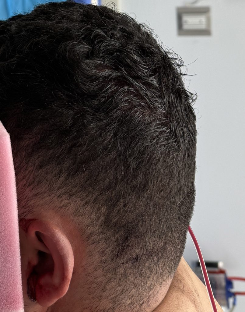 Plastic Surgery Case Study - Custom Skull Implant for Congenital Flat ...