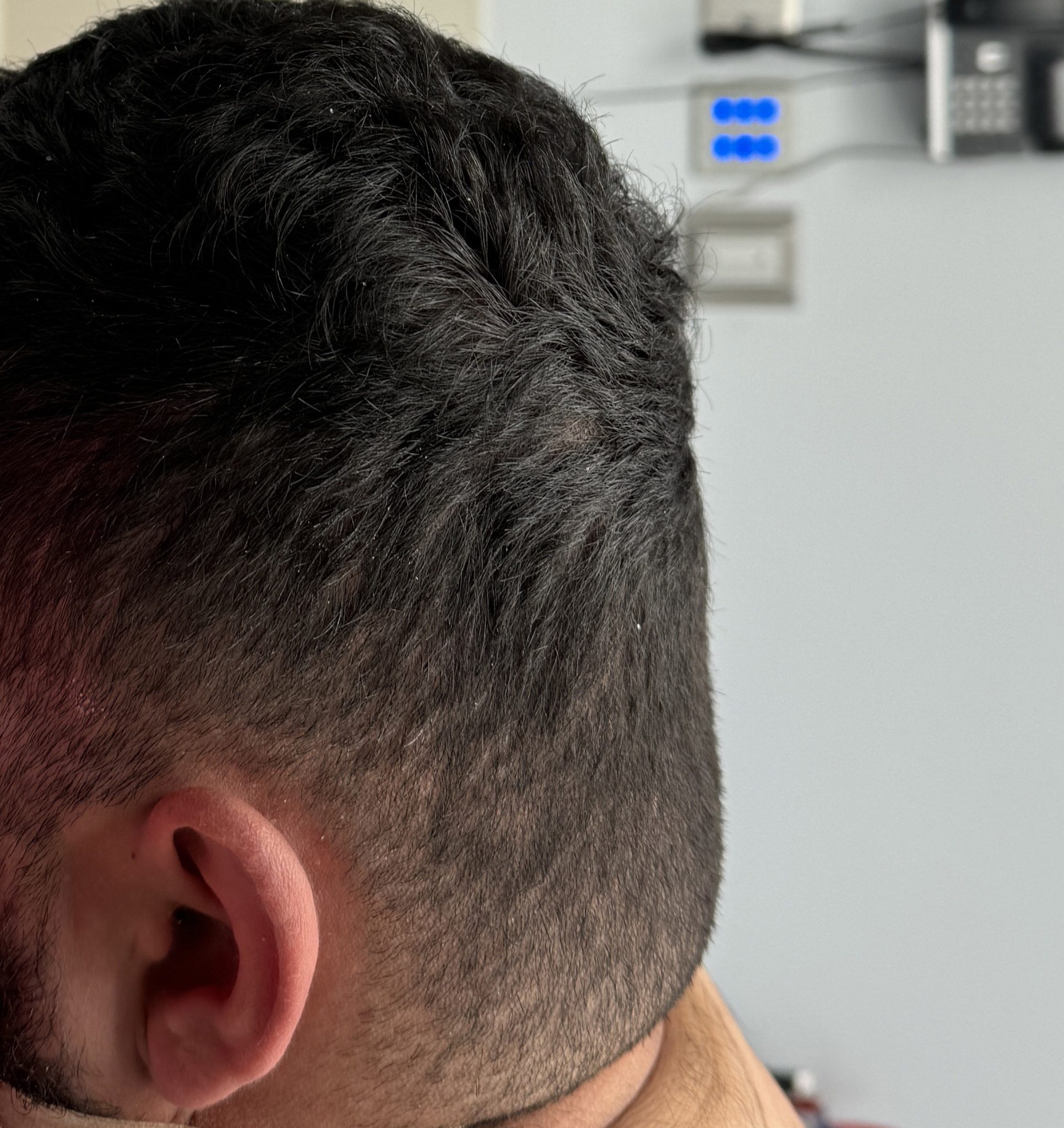 male flat back of head side view intraop - Explore Plastic Surgery