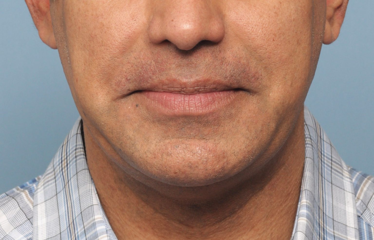 Plastic Surgery Case Study - The Common Unintentional Two Stage Jaw ...