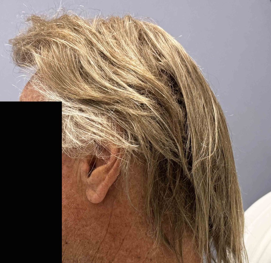 Plastic Surgery Case Study - Male Flat Back of the Head Custom Skull ...