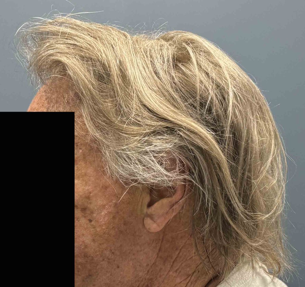 Plastic Surgery Case Study - Male Flat Back of the Head Custom Skull ...