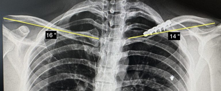 postop xray left clavicle shortening - Explore Plastic Surgery