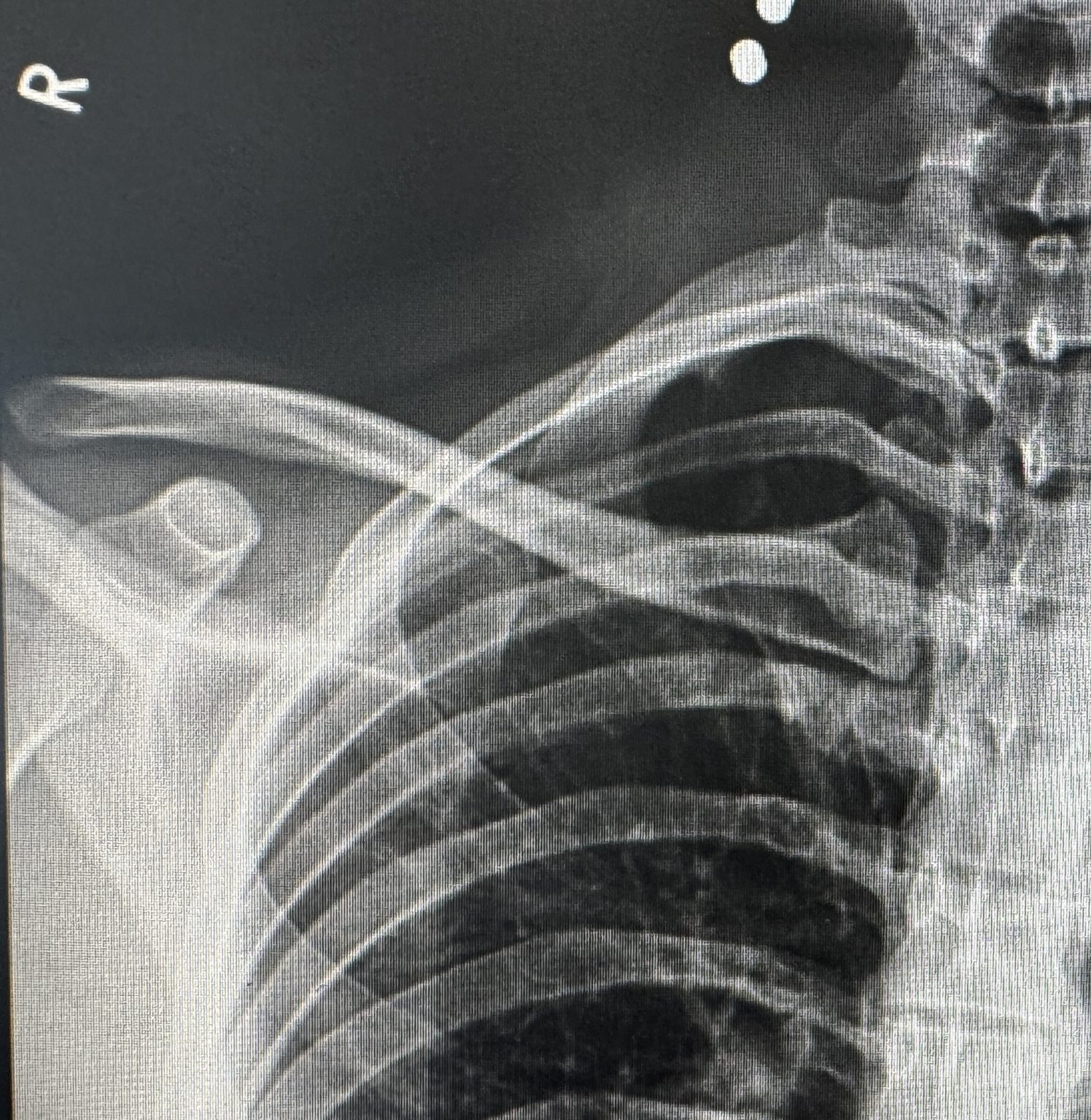 Plastic Surgery Case Study - The Staged Approach to Shoulder Narrowing ...