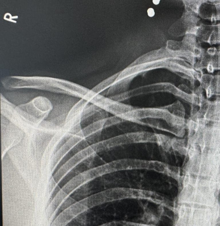 right clavicle x-ray Dr Barry Eppley - Explore Plastic Surgery