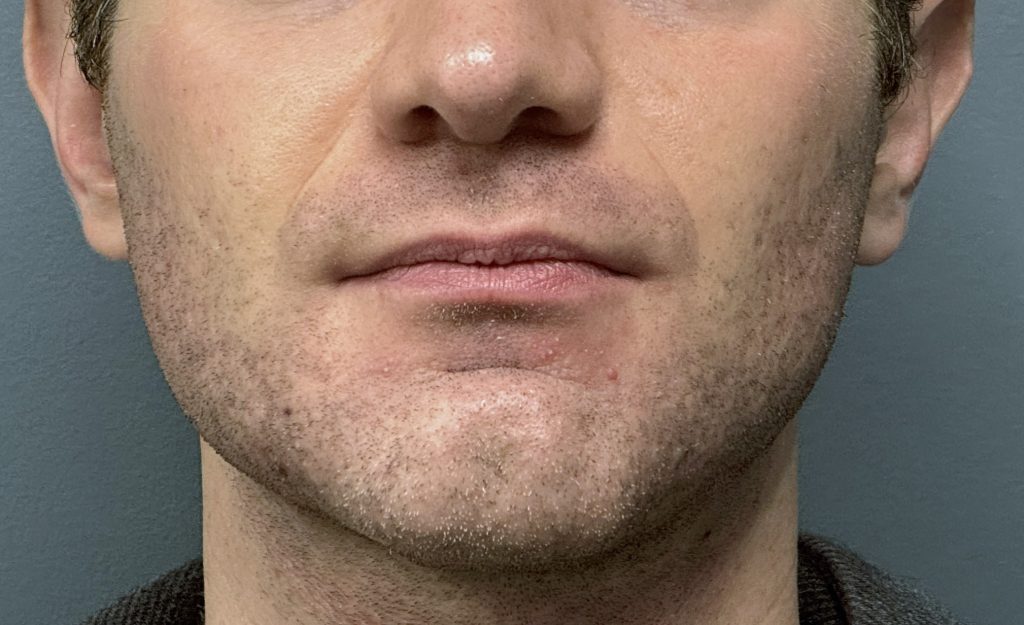 Plastic Surgery Case Study - Custom Jawline Implant after Vertical Bony ...