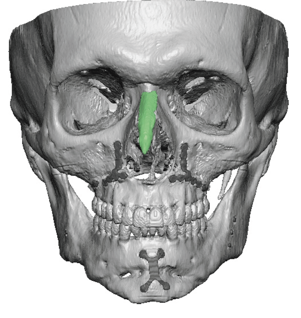 vertical chin lengthening result front view 3D CT scan Dr Barry Eppley ...