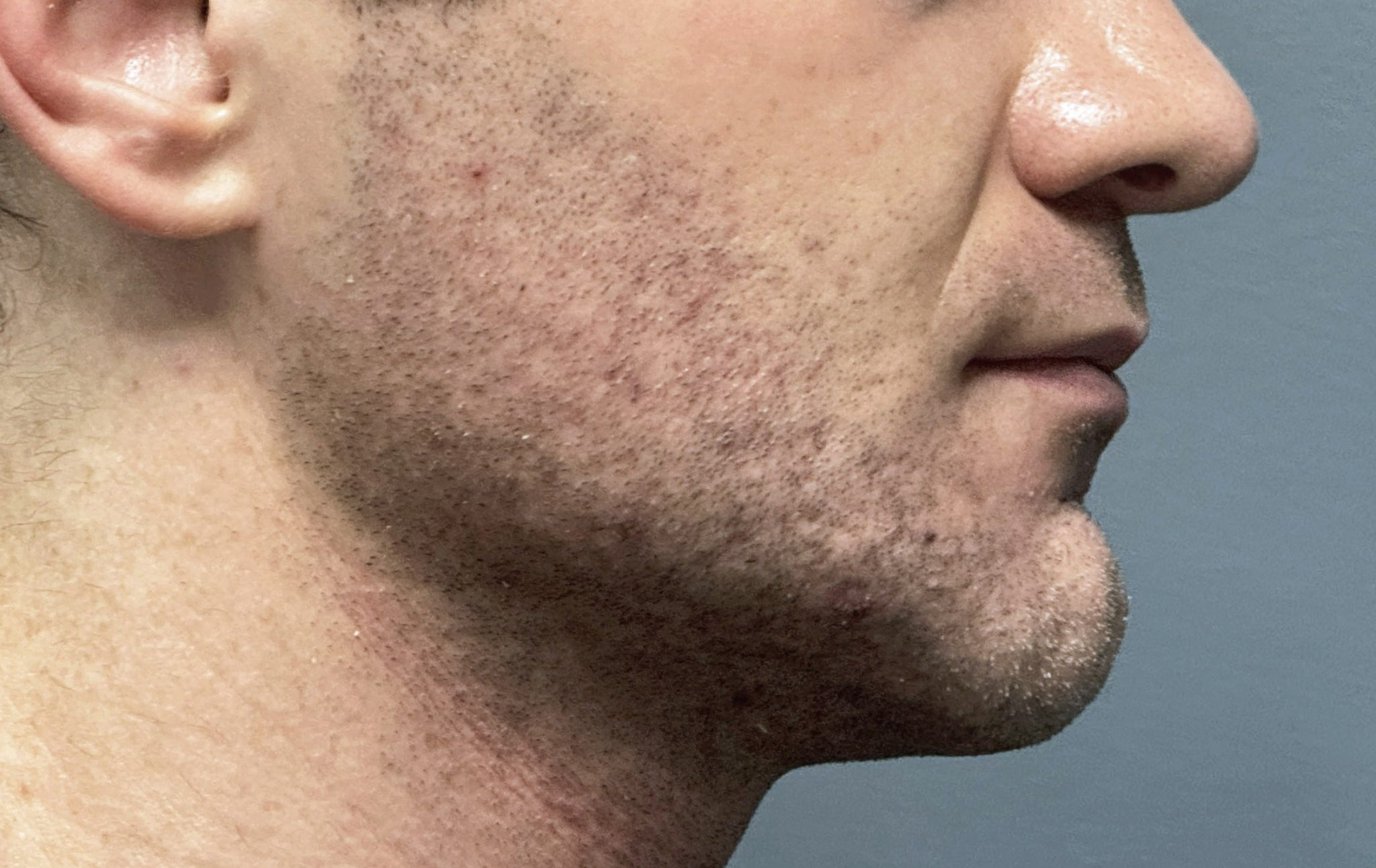 Plastic Surgery Case Study - Custom Jawline Implant after Vertical Bony ...