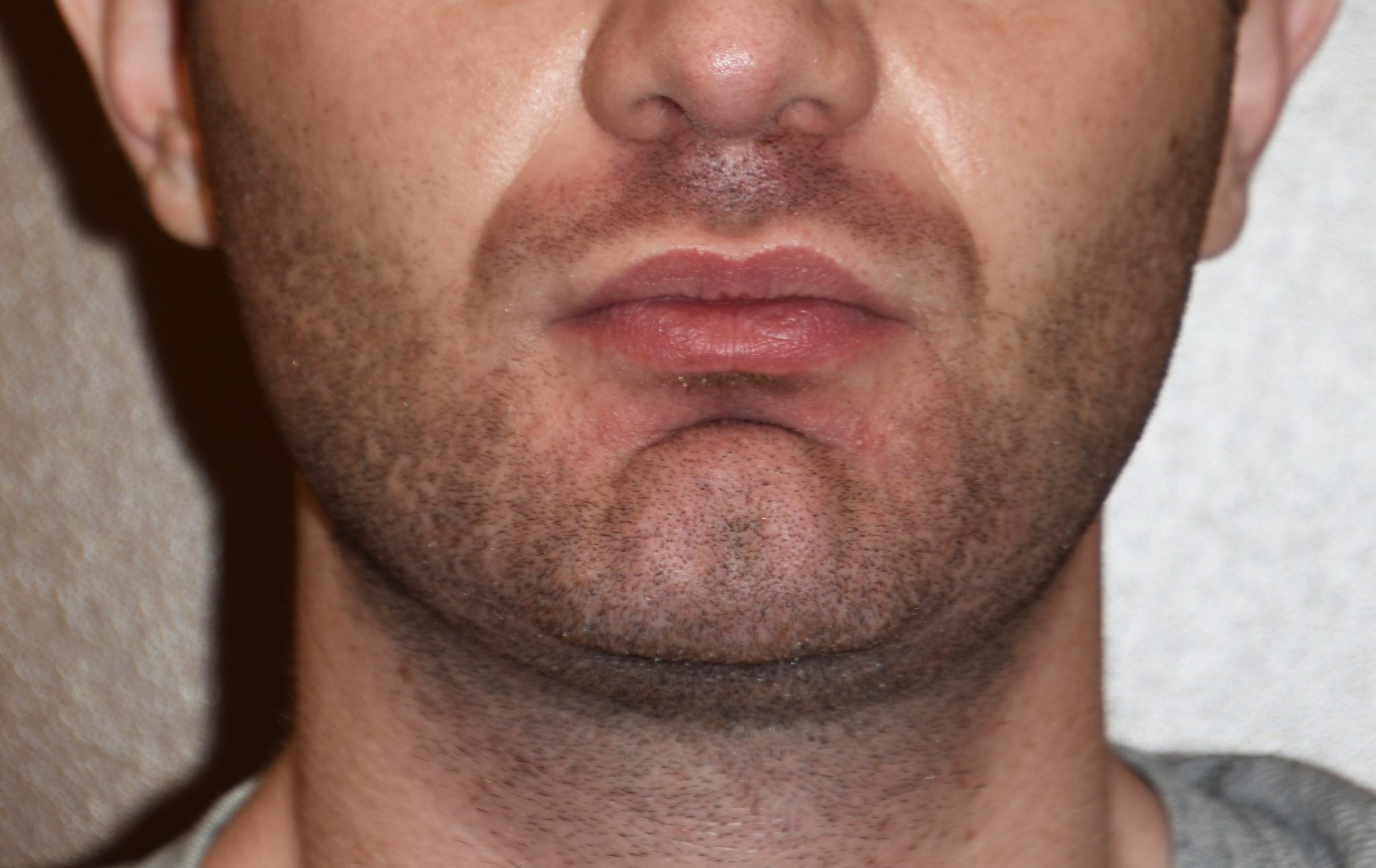 Plastic Surgery Case Study - Custom Jawline Implant after Vertical Bony ...