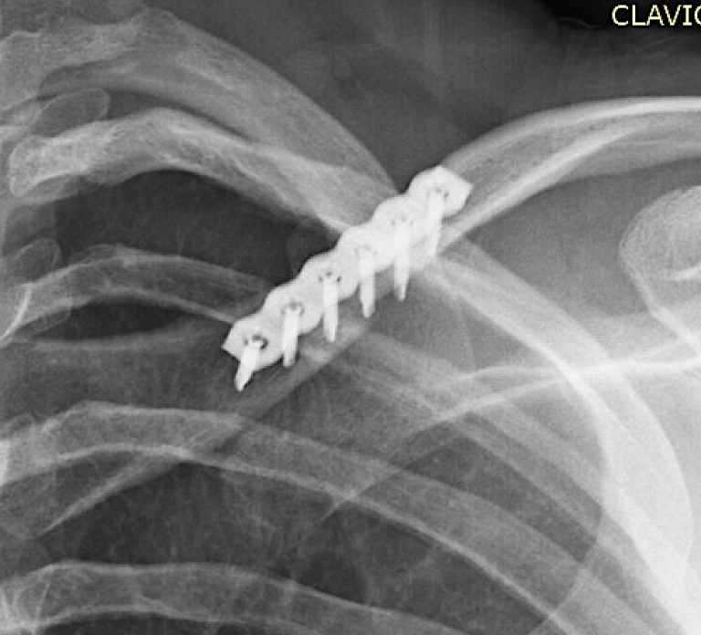 3 month postop xray left clavicle osteotomy Dr Barry Eppley - Explore ...