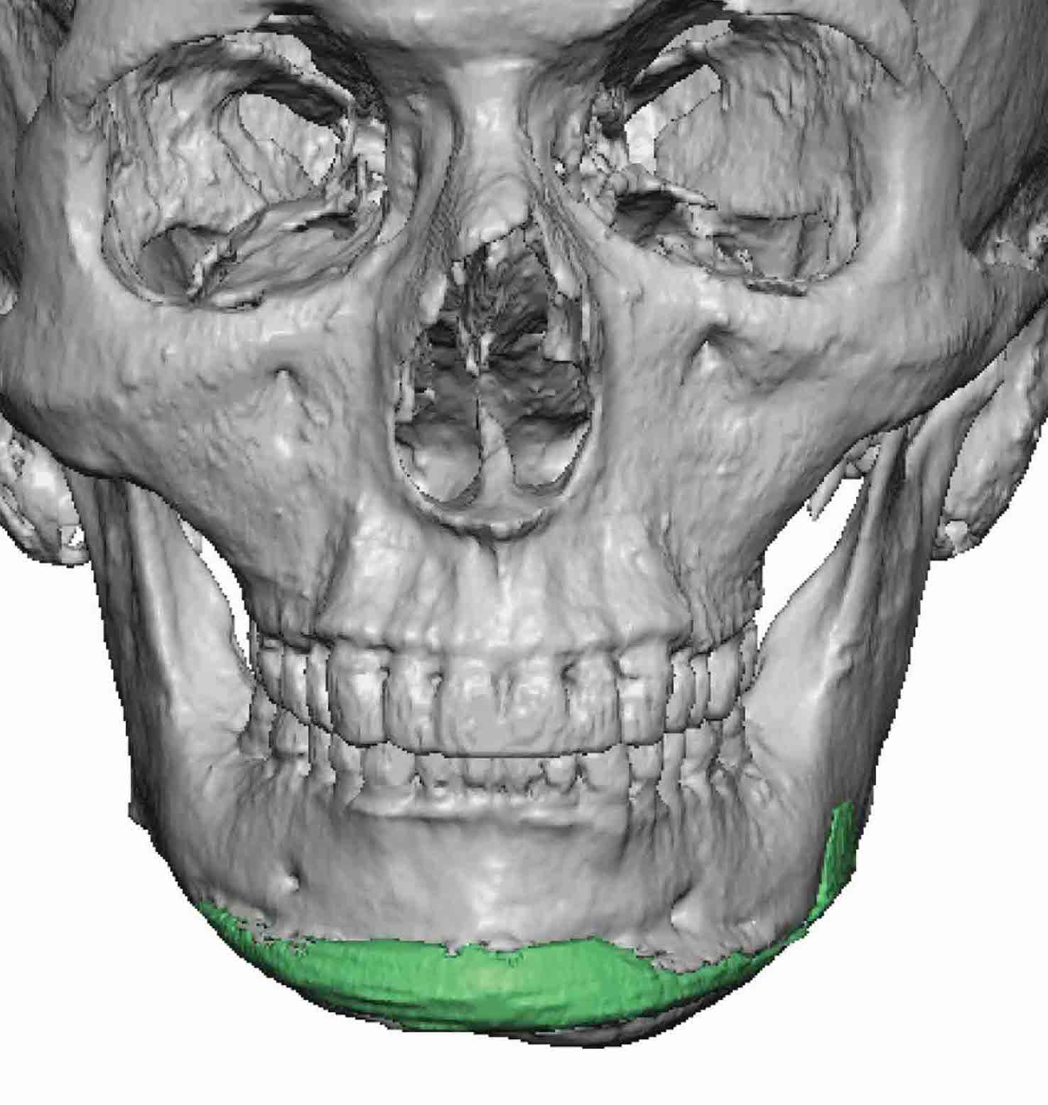 Male chin implant 3D CT scan front view Dr Barry Eppley - Explore ...