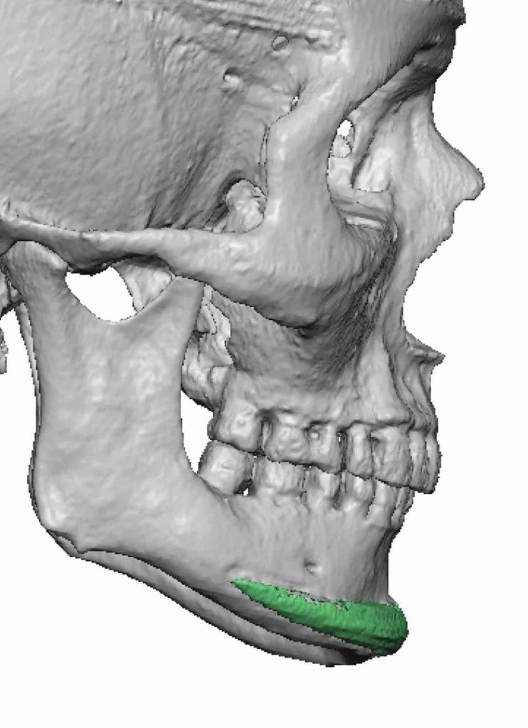 Plastic Surgery Case Study - Male Custom Jawline Implant To Favorably ...