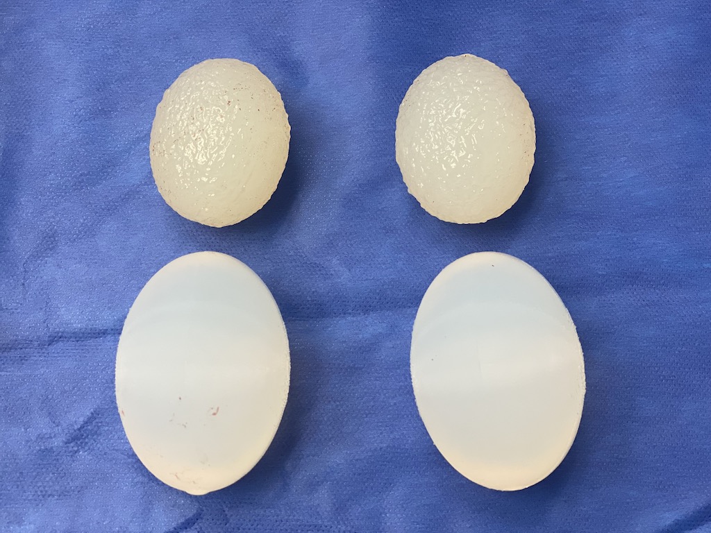 Postoperative Scotal Settling Relaxation After Custom Testicle Implants
