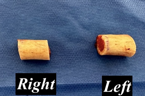 bone removal in shoulder asymmetry Dr Barry Eppley - Explore Plastic ...