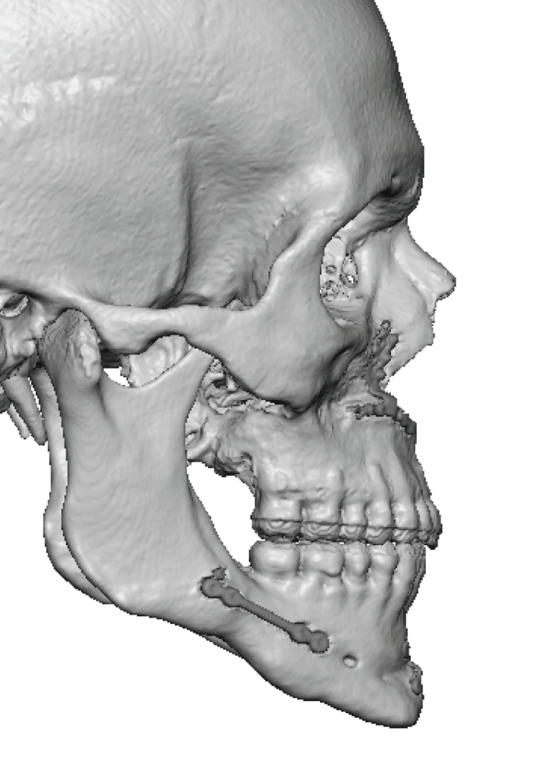 Plastic Surgery Case Study - Custom Infraorbital-Malar Implants To ...