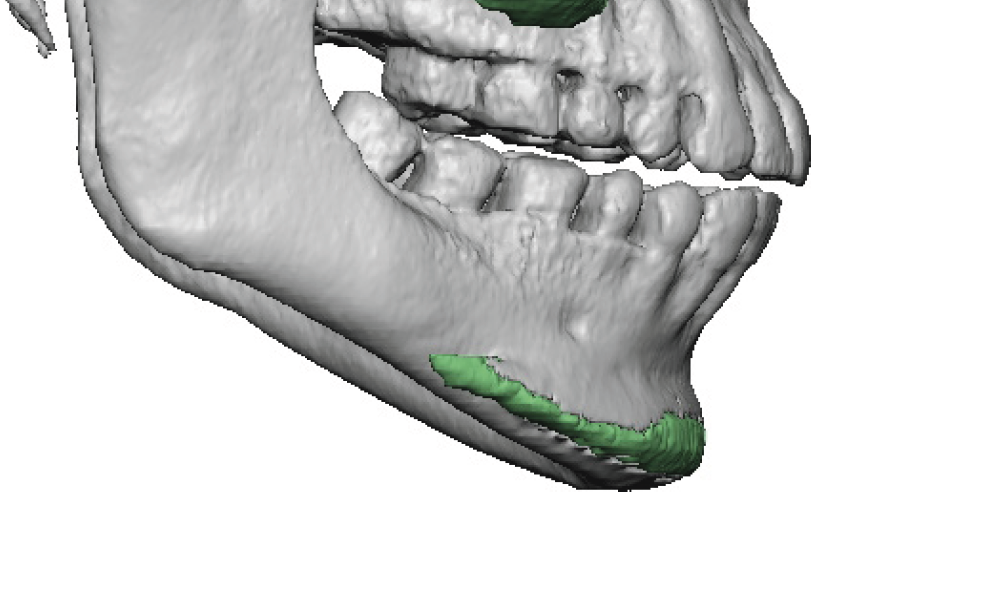 chin implanrt 3D CT scan Dr Barry Eppley - Explore Plastic Surgery
