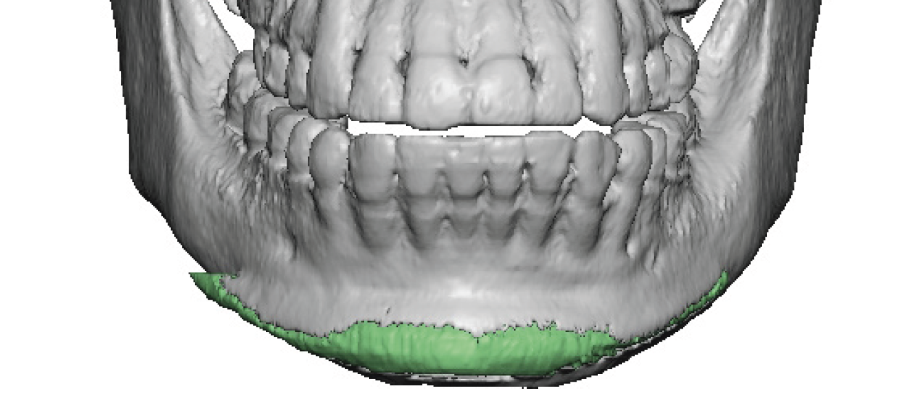 chin implant 3D CT scan front view DR Barry Eppley - Explore Plastic ...