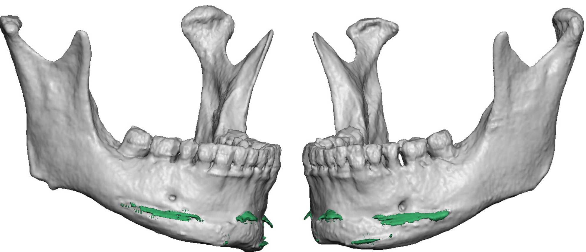 chin implant bione overgrowth 3D CT scan Dr Barry Eppley - Explore ...