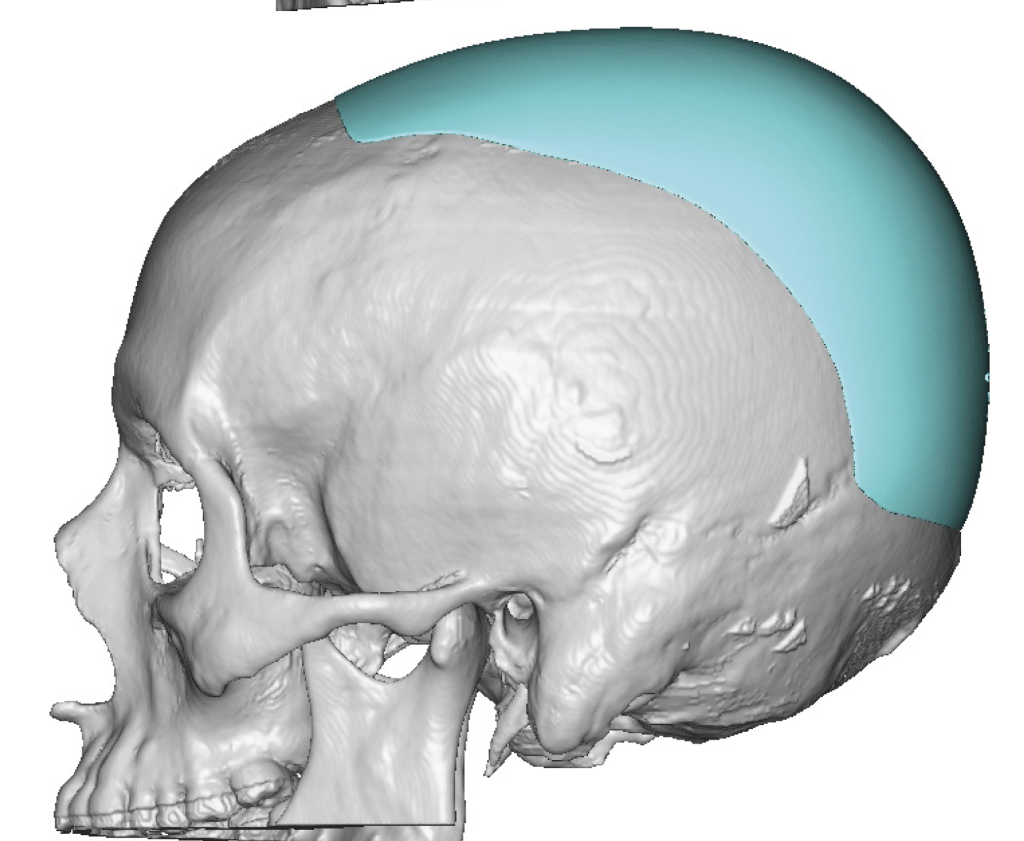 Plastic Surgery Case Study - Custom Skull Implant Correction of The ...