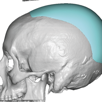 skull reshaping Archives - Explore Plastic Surgery