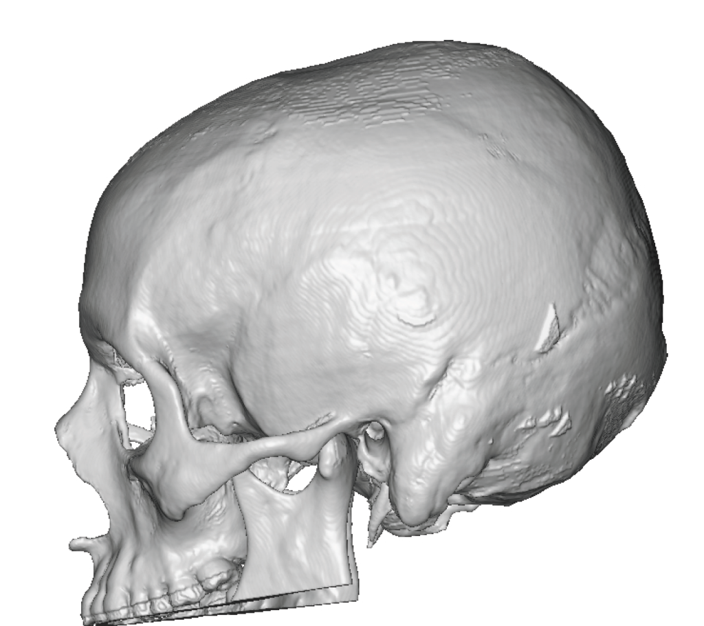 Plastic Surgery Case Study - Custom Skull Implant Correction of The ...