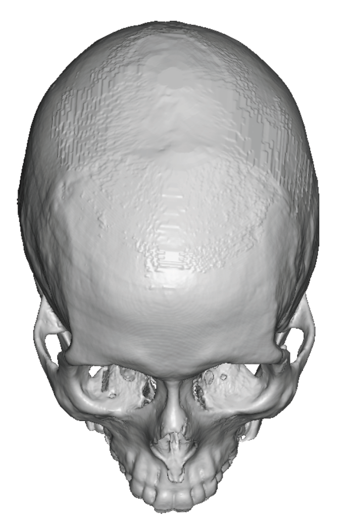 coronal dip skull deficiency 3D CT scan top view DR Barry Eppley ...
