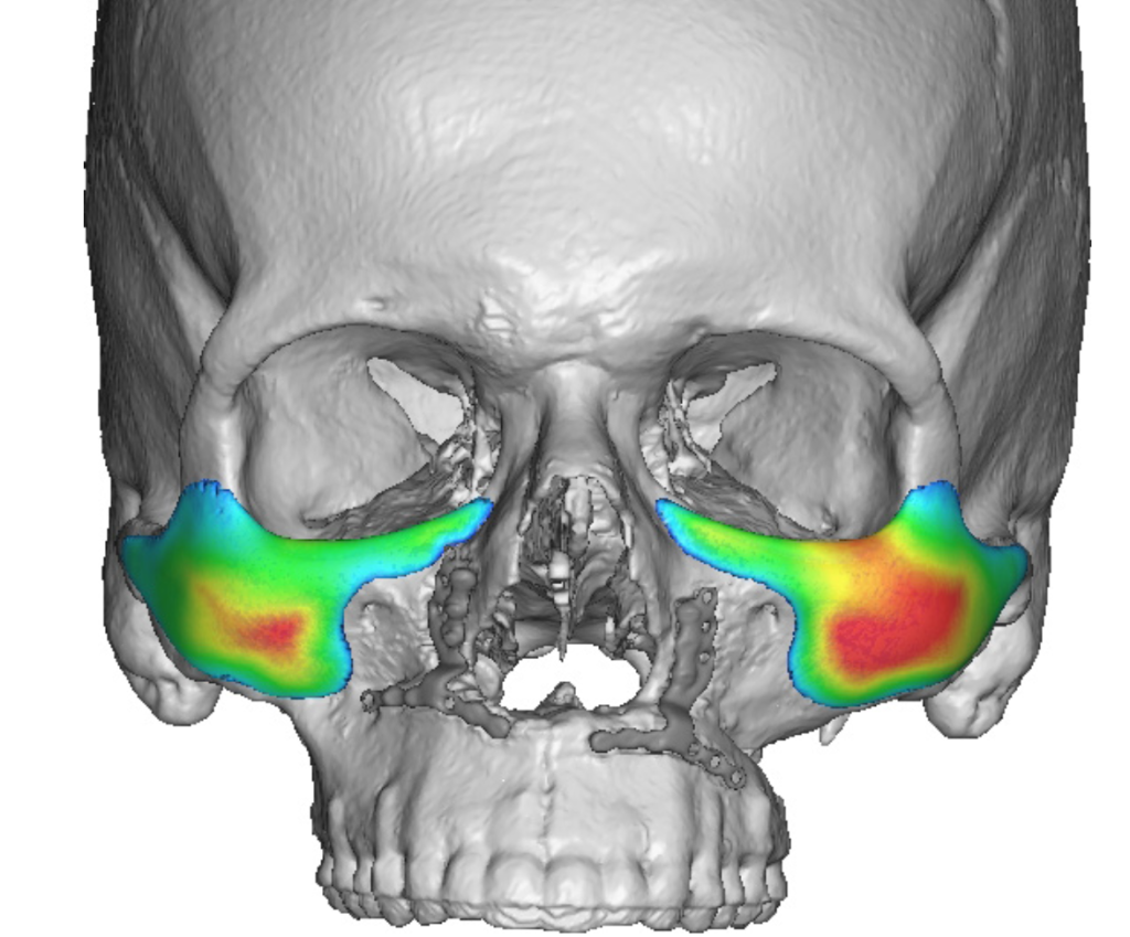 Plastic Surgery Case Study - Custom Infraorbital-Malar Implants To ...