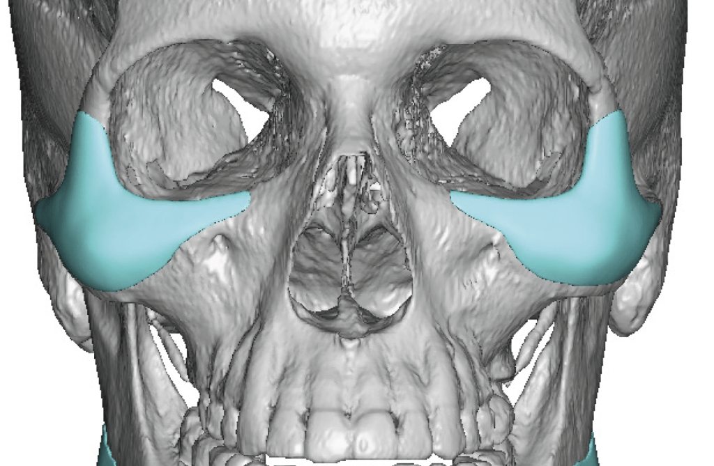 custom cheek implant repalcements design front view Dr Barry Eppley ...