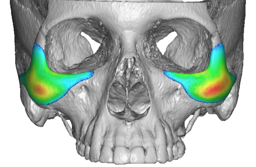 Plastic Surgery Case Study - Custom Cheek Implant Replacements for ...