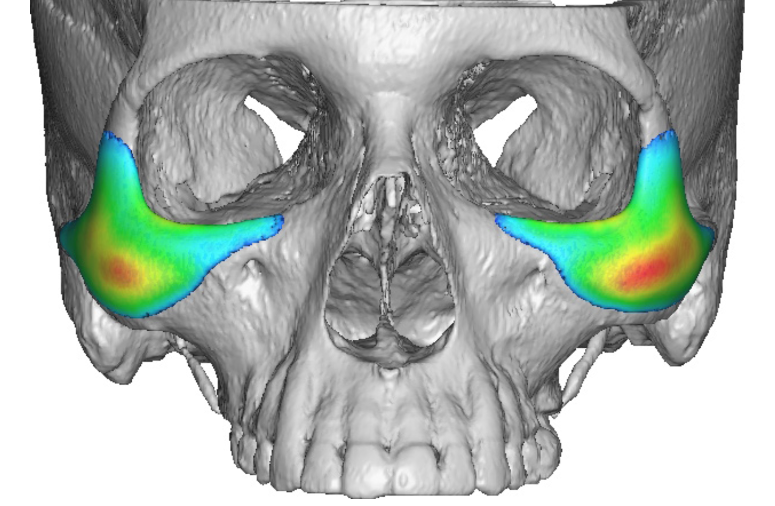 Plastic Surgery Case Study - Custom Cheek Implant Replacements for ...