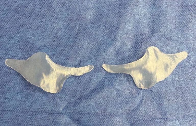 Plastic Surgery Case Study - Custom Infraorbital-Malar Implants To ...
