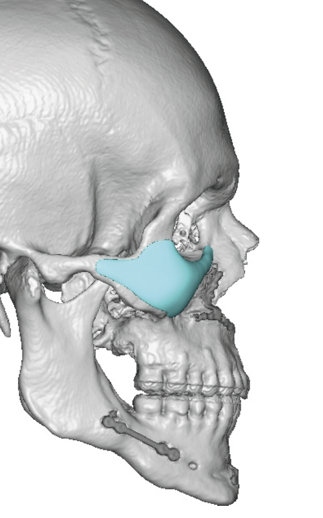 custom infraorbital-malar implants design side view Dr Barry Eppley ...