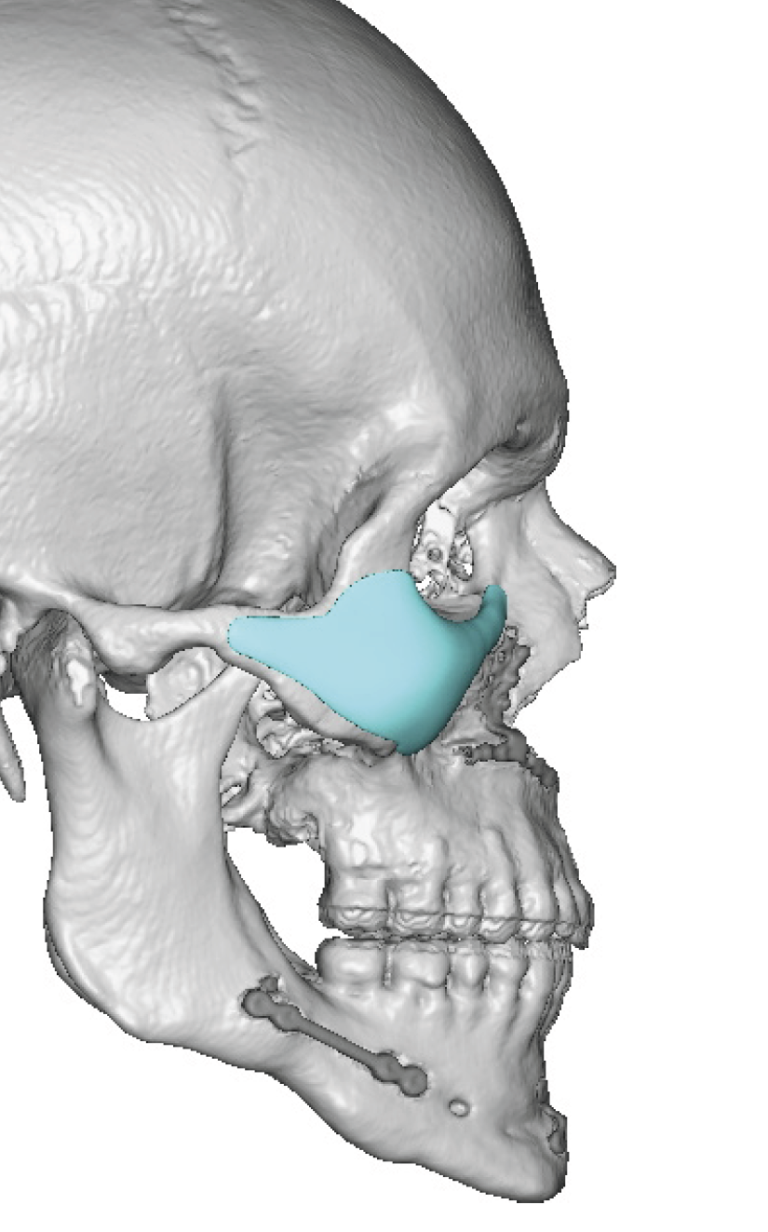 custom infraorbital-malar implants design side view Dr Barry Eppley ...