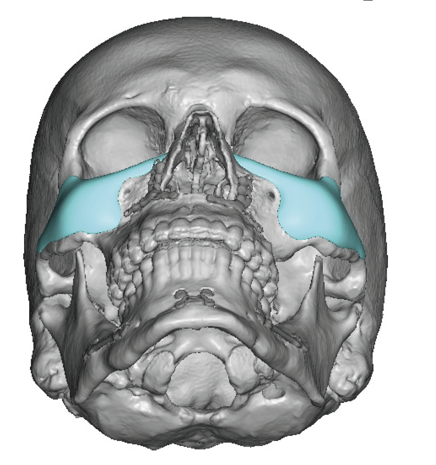 Plastic Surgery Case Study - Custom Infraorbital-Malar Implants To ...