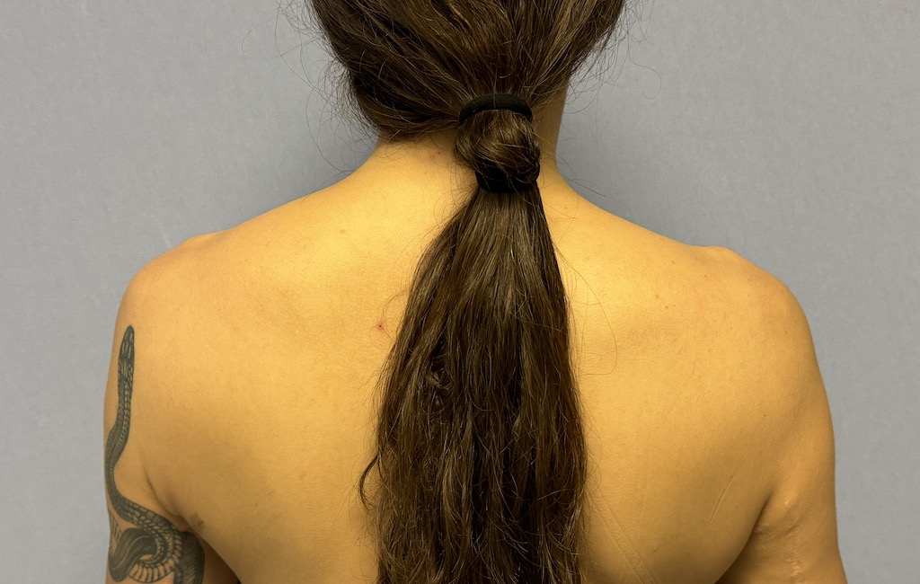 femakle shoulder asymmetry back view Dr Barry Eppley - Explore Plastic ...