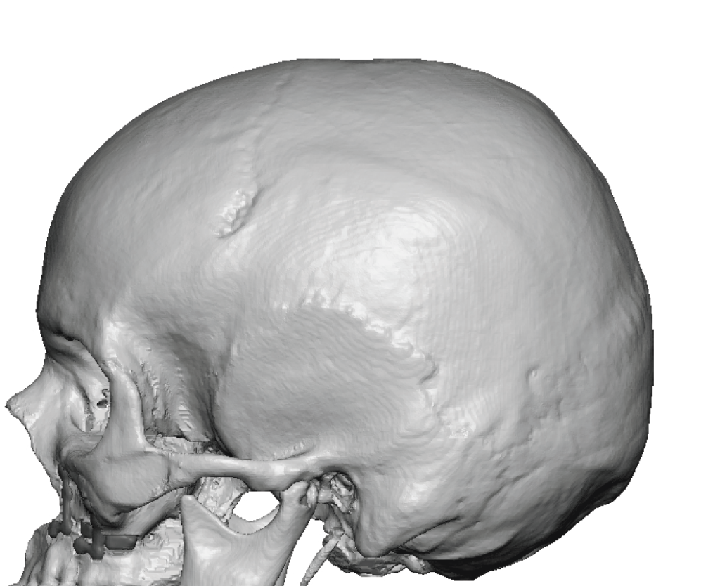 Plastic Surgery Case Study - 70 Year Old Female for Custom Crown of the ...