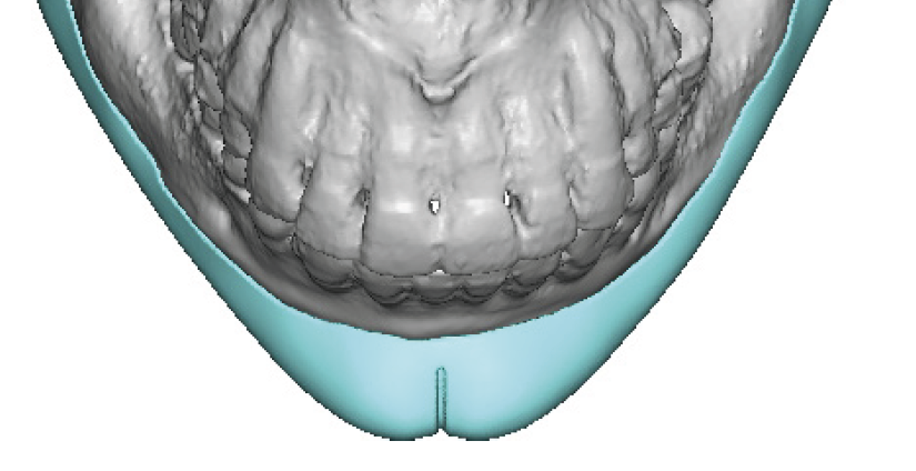 female custom jawline implant 3D Ct scan top view Dr Barry Eppley ...