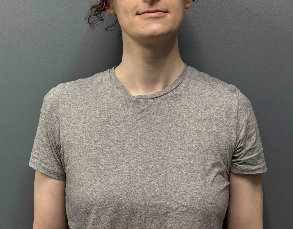 female left shoulder reduction front 2 Dr Barry Eppley - Explore ...