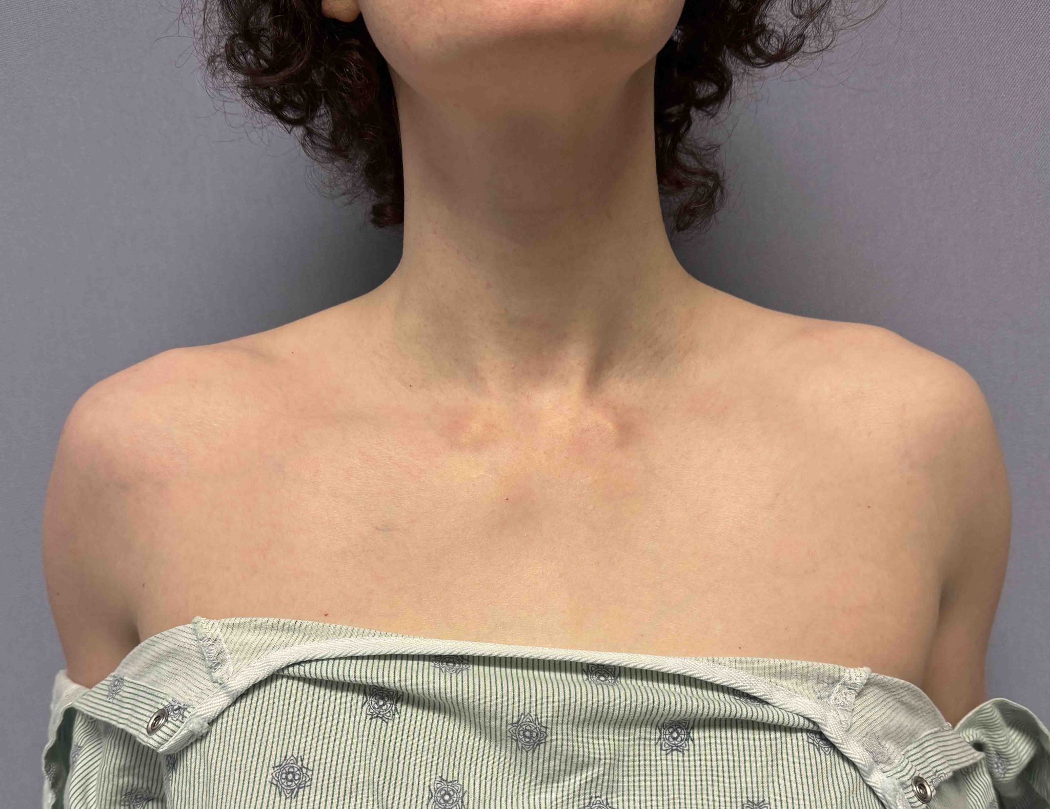 Plastic Surgery Case Study - 1st Stage Left Shoulder Narrowing Surgery ...